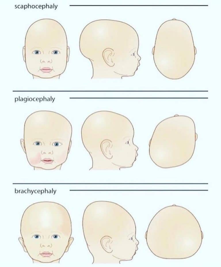The Different Types of Flat Head Syndrome - Flat Head Syndrome Treatment